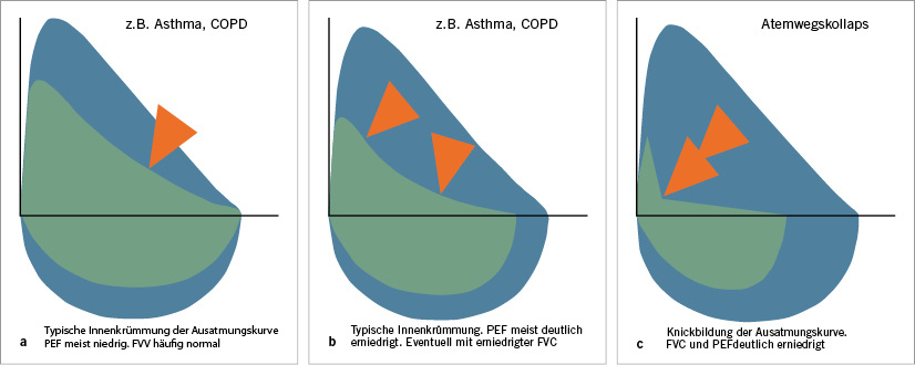Leitlinie der Deutschen Atemwegsliga, der Deutschen Gesellschaft für ...